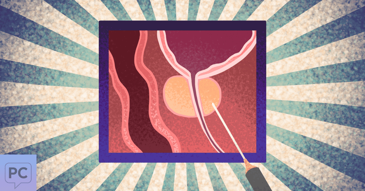 Transperineal: A Newer Type of Biopsy for Prostate Cancer