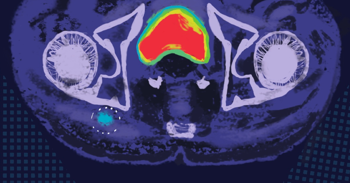 PSMA-Targeted PET Imaging Drugs for Prostate Cancer
